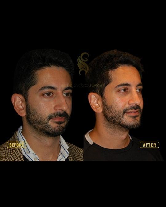 Rhinoplasty Before After Gold Clinic Turkey a10 – Gold Clinic Turkey